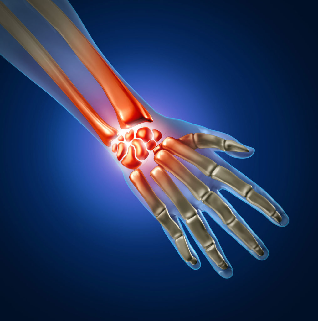 Carpel Tunnel Syndrome - Holt Osteopaths
